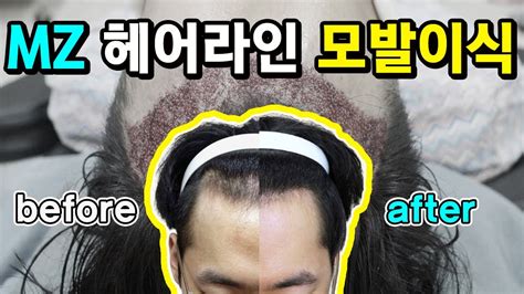 비절개모발이식 20대 남성 헤어라인 모발이식 1년 경과 리얼후기 전후사진 동영상 Youtube