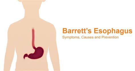 Barretts Esophagus Symptoms Causes And Prevention Baldota