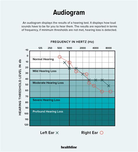 Occupational Hearing Loss Audiogram