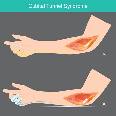 Cubital Tunnel Release Treatment And Recovery Joi Jacksonville Orthopaedic Institute