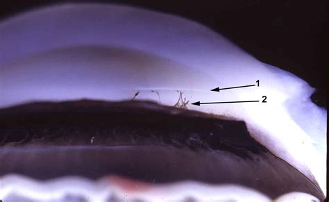 Ocular Pathology Axenfeld Anomaly And Syndrome
