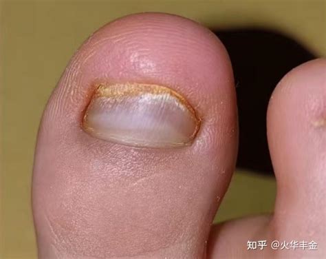 灰指甲根除的秘密，拔甲之前一定要三思