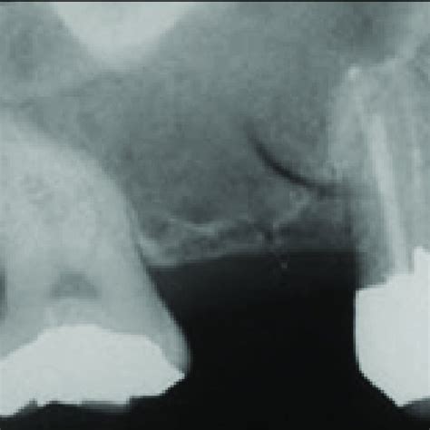 Pre Operative Radiograph Download Scientific Diagram