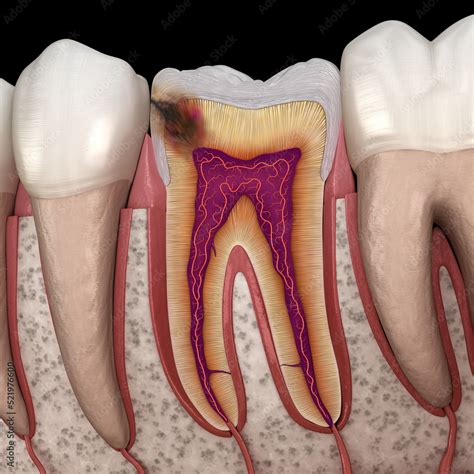 Hidden Caries In To Molar Tooth Medically Accurate 3d Illustration