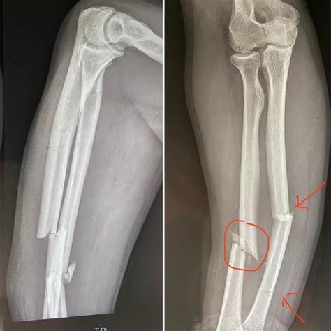 Radius Shaft With Segmental Ulna Fracture Segmental Fractures Are Always Tricky In This Case