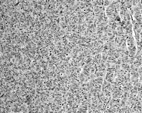 Uterine Tumour Resembling An Ovarian Sex Cord Tumour Journal Of Clinical Pathology