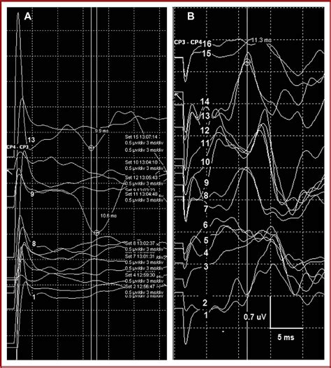 Figure 1 From Dorsal Column Mapping Via Phase Reversal Method The