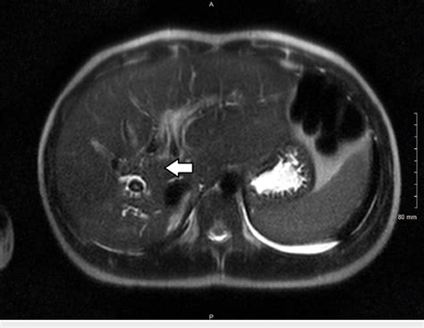 Magnetic Resonance Cholangiopancreatography Confirmed Findings Of Download Scientific Diagram