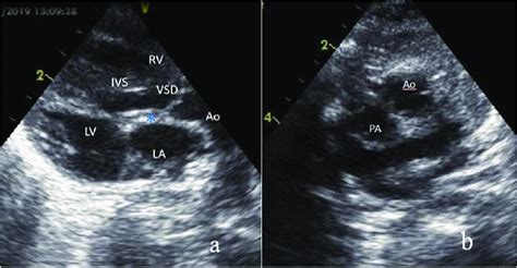 A Transthorasic Echocardiography Showed Subaortic Malalignment