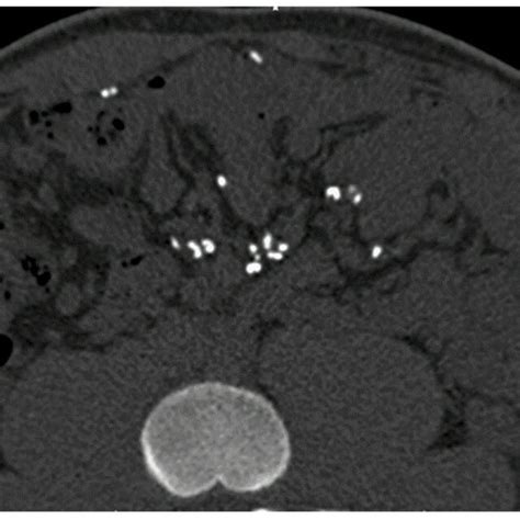 Unenhanced Ct Scan Demonstrating Multiple Comma Shaped Calcifications