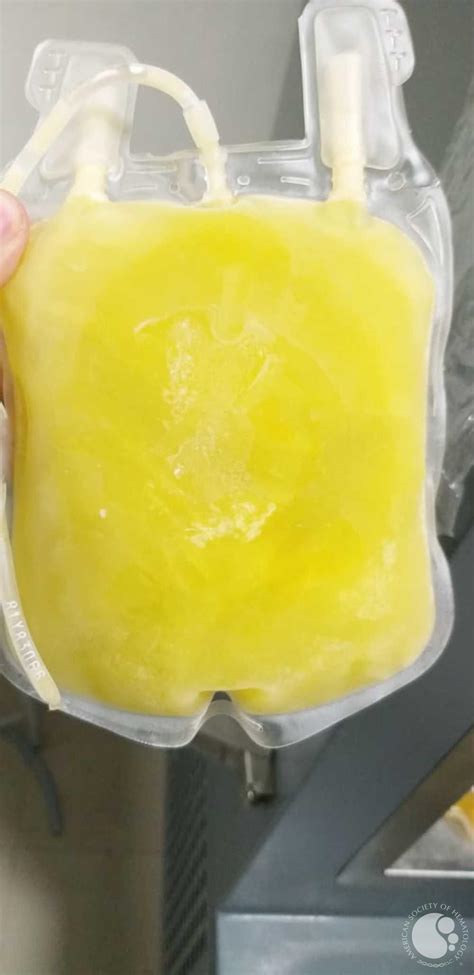 Plasma Discoloration In A Female Blood Donor On Oral Contraceptive Pill