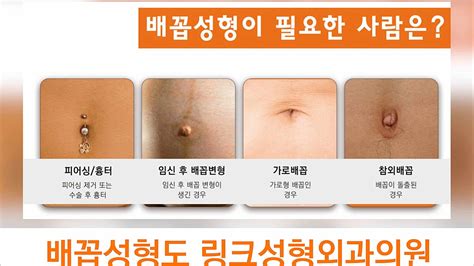 배꼽성형 배꼽수술 링크성형외과 성하민원장 정민수원장 네이버 Tv