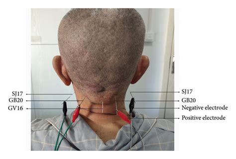 Sj17 Gb20 And Gv16 Acupoints A Back B Front Download