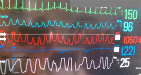 Pedi Cardiology Pulsus Paradoxus