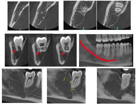 Simple Bone Cyst Mandible