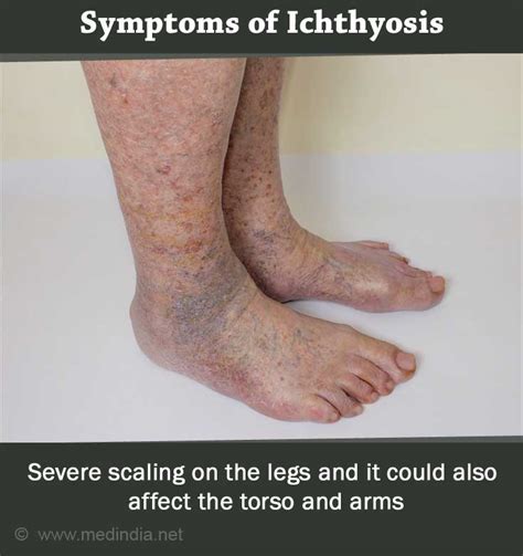 Ichthyosis Symptoms Causes And Natural Treatment