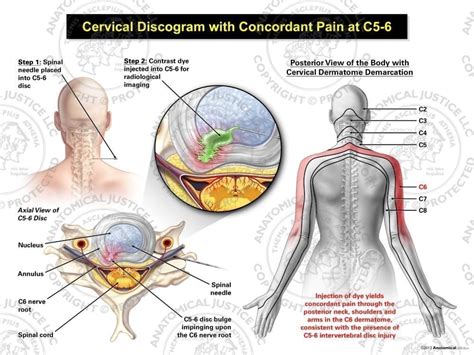 Cervical Cord Compression Cervical Spinal Stenosis Bytkck
