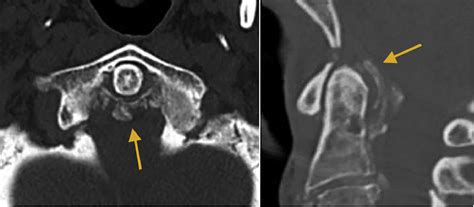 Cervical Ct Dependent Diagnosis Of Crowned Dens Syndrome In Calcium