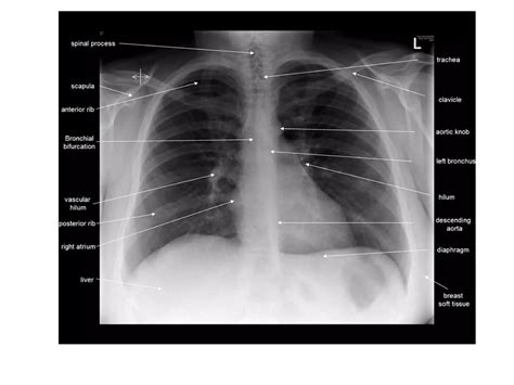 1 The Normal Cxr Ppt
