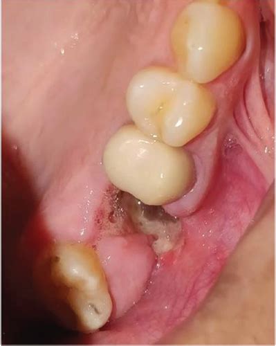 Management Of Oroantral Fistulae And Communications Our