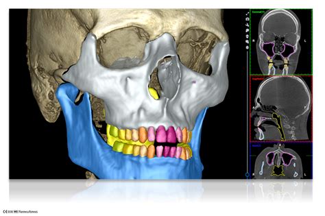 planmeca introduces new ai based tools for planmeca romexis®