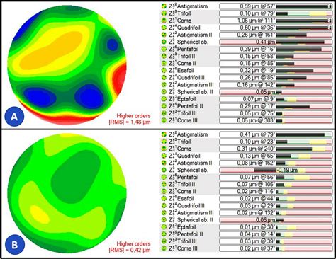 Preoperative And Postoperative Corneal Wavefront Analysis Of A Patient