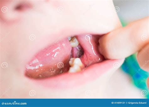 Wisdom Teeth Removal Hole