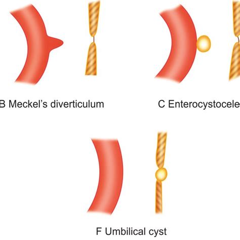 3 Abnormalities Of Omphalomesenteric Duct Download Scientific Diagram