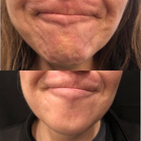 Pebble Chin And Dimples With Botox How It Works Cost And More