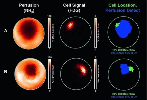Polar Map Analysis Of Perfusion Defect And Early Retention Of Download Scientific Diagram