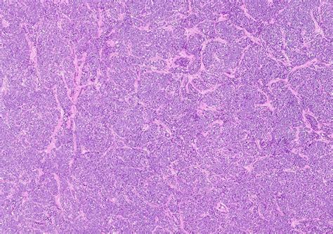 Pathology Outlines Gli1 Altered Soft Tissue Tumors