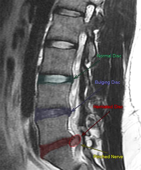 Minimally Invasive Microdiscectomy Manhattan Spine Consultants