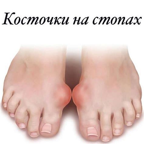 Zhanna Alshevskaya Alshevskaya • Фото и видео в Instagram Подагра Instagram Лечение ног