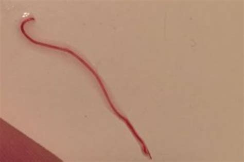 Easy Methods To Get Rid Of Red Worms Camallanus Capillria Worm