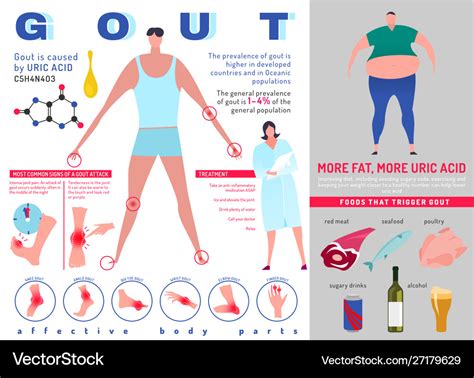 Gout Arthritis Infographic Royalty Free Vector Image