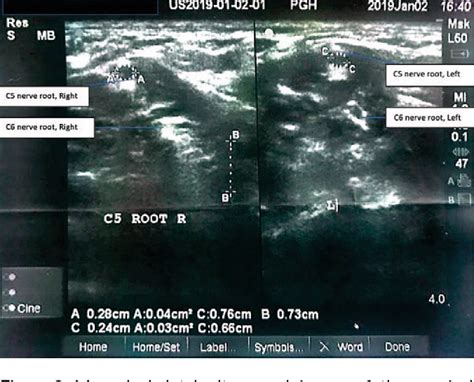 Figure 2 From Allodynia In Cervical Polyradiculopathy Due To Low