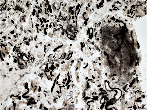 Thyroid Ophthalmopathy