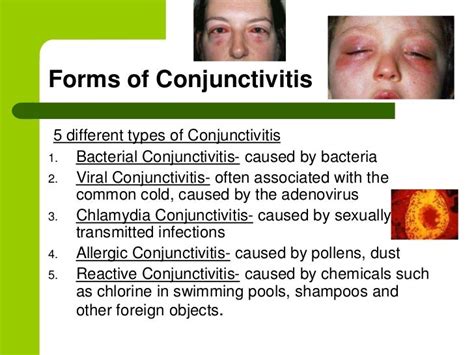 Uveitis Vs Conjunctivitis