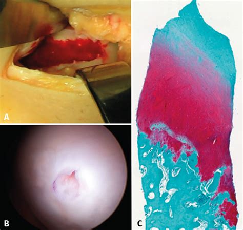 Microfractures Or Bone Marrow Stimulation Bms Evolution Of The