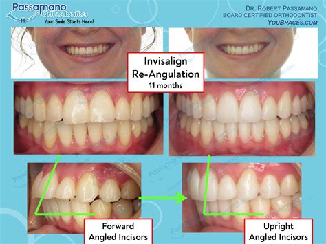 Teeth Before And After Invisalign