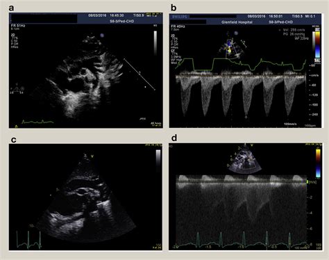 Presentation Of Coarctation Of The Aorta In The Neonates And The Infant