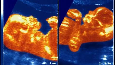معمای کروموزوم‌ها در خون یک زن؛ خواهری که کروموزم‌های برادرش را دارد