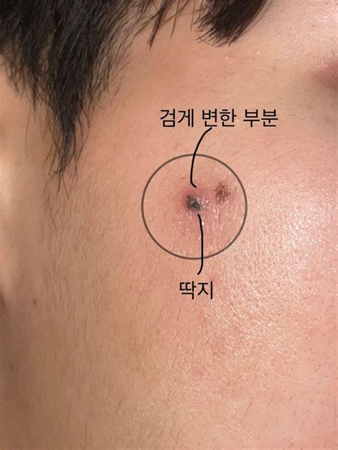 얼굴에 피지제거 후 딱지가 안사라집니다 지식in