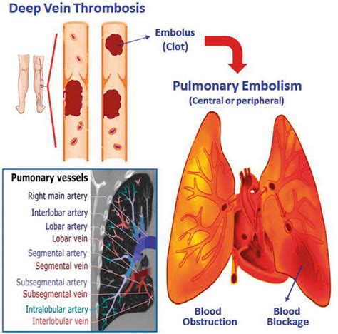 Computer Aided Detection Pulmonary Embolism Computerized Tomography Pulmonary Angiography