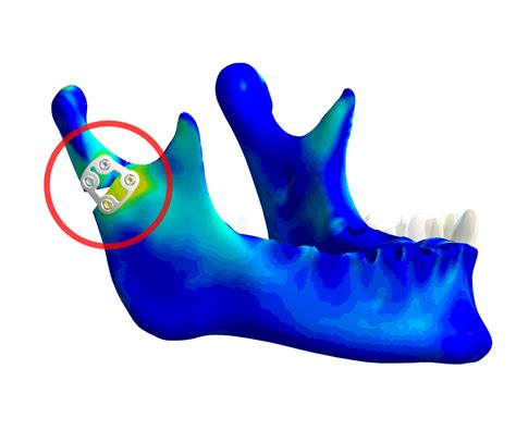 The Science Behind A Healing Jaw Finite Element Analysis Of Mandibular