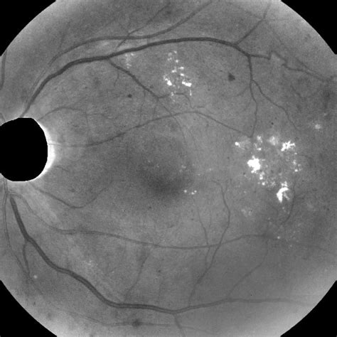 Pdf Automatic Detection Of Hard And Soft Exudates From Retinal Fundus Images
