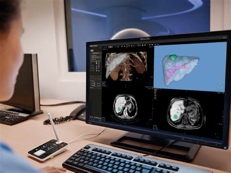 Philips Intellispace Portal 11 Ice