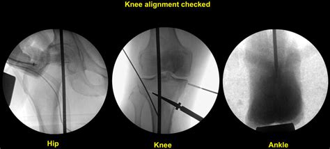 Knee Alignment Is Checked With Fluoroscopy Ensuring That The Download Scientific Diagram