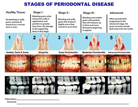 What Are The Classifications Of Periodontal Disease At William