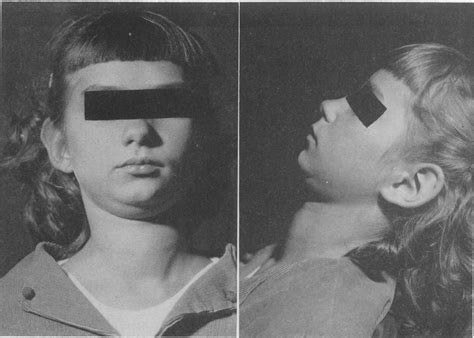 35 Facts About Hashimoto Struma